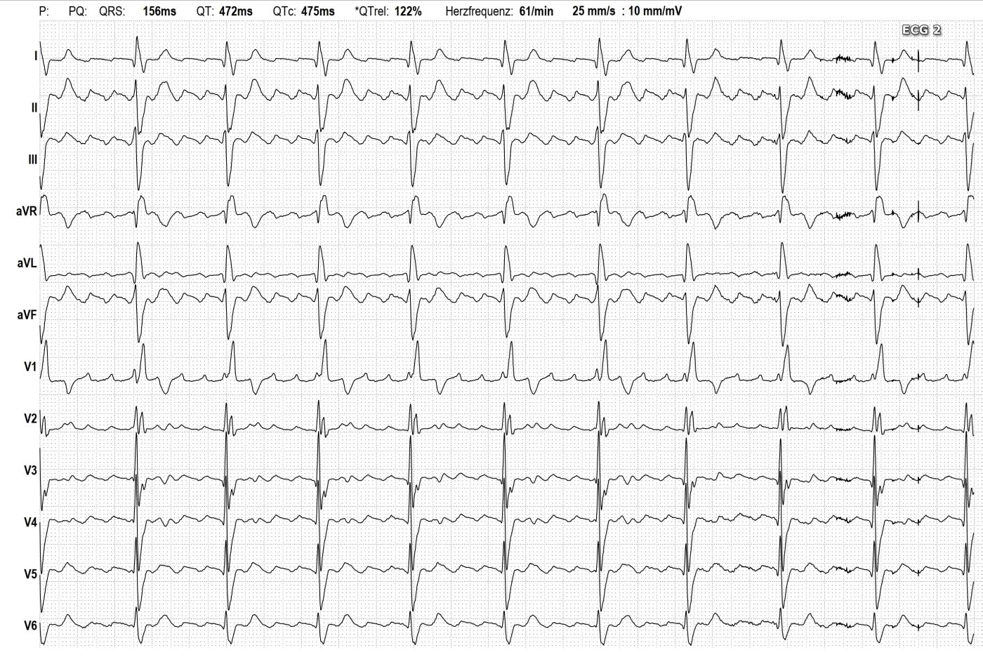 Atypical Atrial Flutter Ecg Guru Instructor Resources